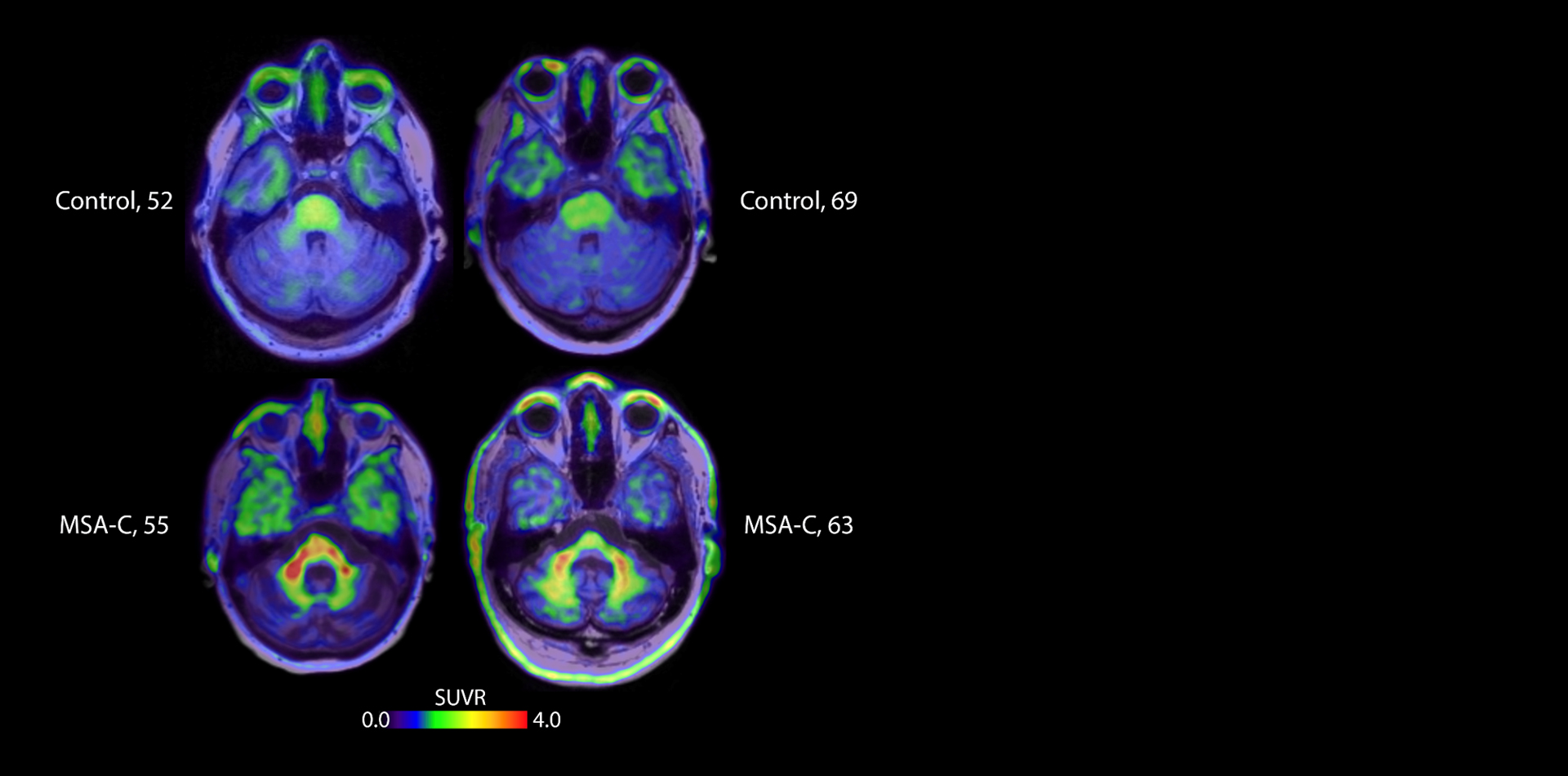 AC Immune SA | Precision medicine for neurodegenerative diseases